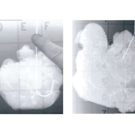 Tissue Transfer and X-Ray System - Halomedicals Systems - USA